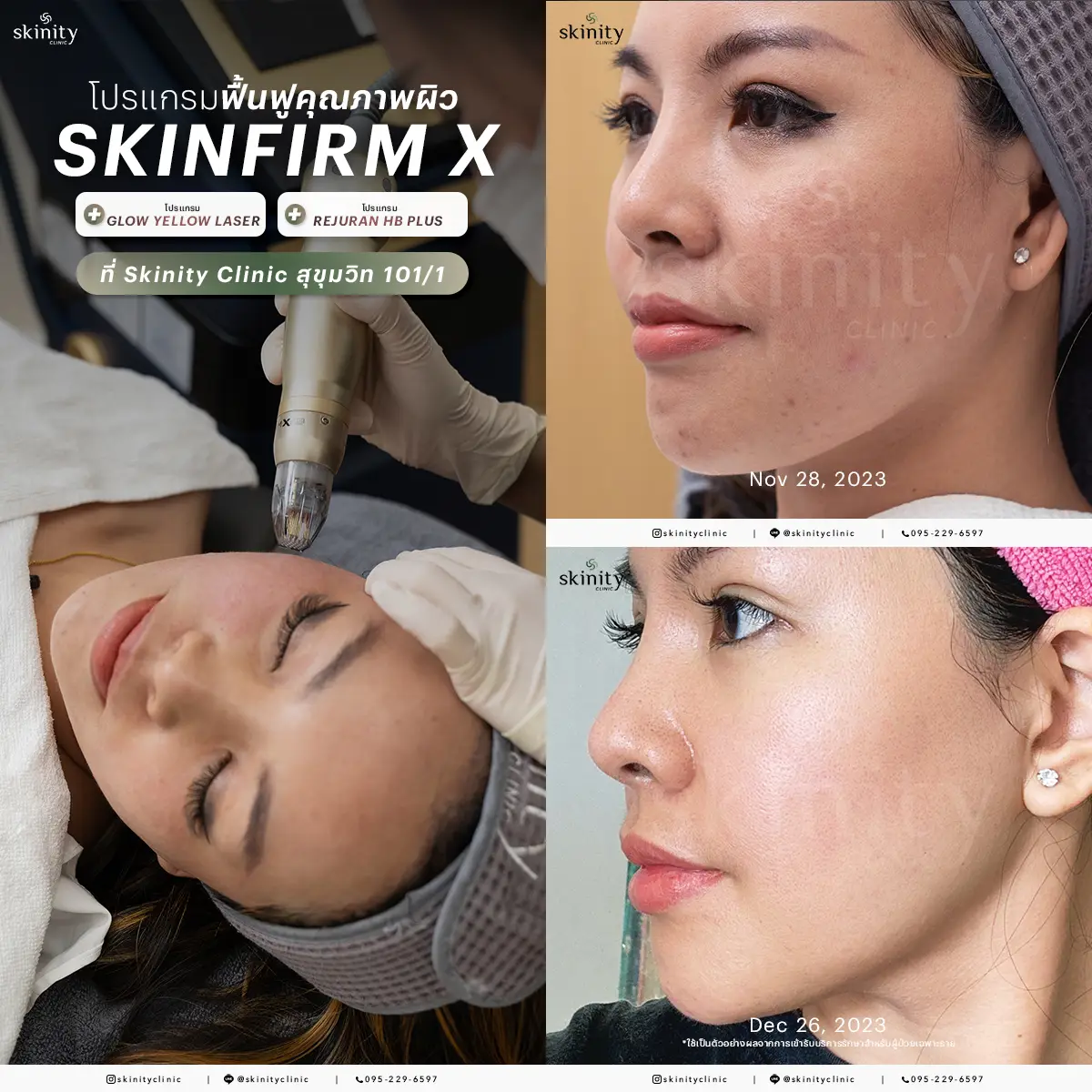 Sylfirm X Plus รักษาหลุมสิว รูขุมขนกว้าง แก้ปัญหารอยแดง รักษาฝ้า ยกกระชับใบหน้า - Skinity Clinic